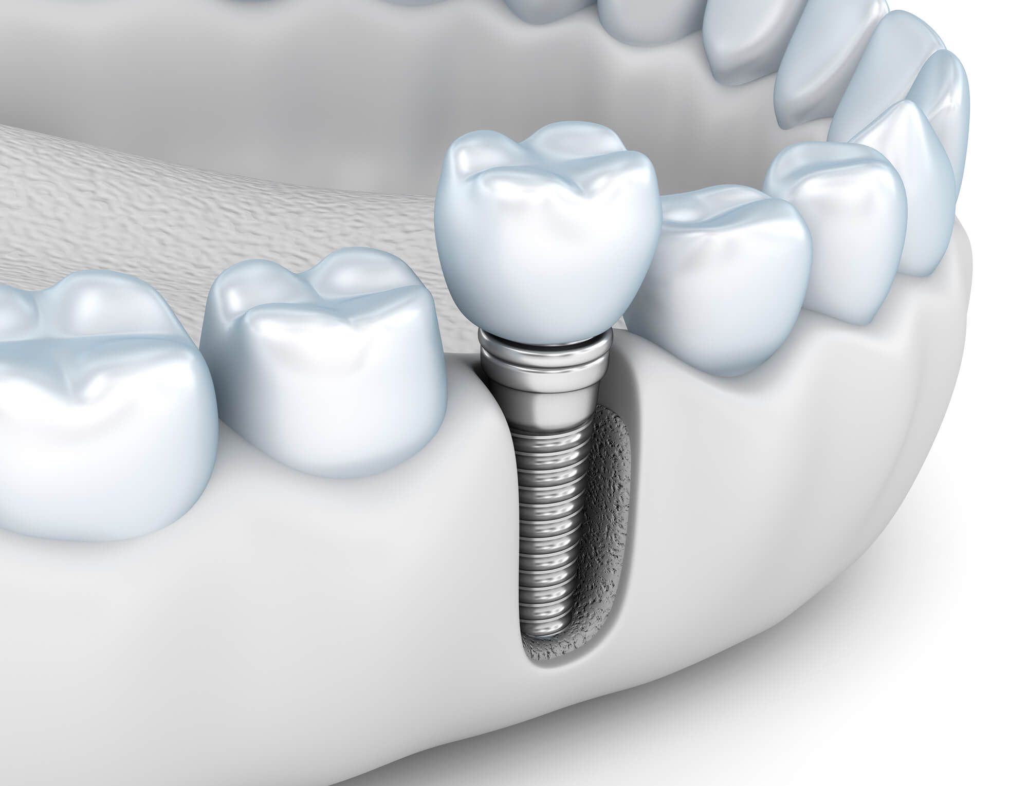 Single Implant Placement Surgery: What to Expect