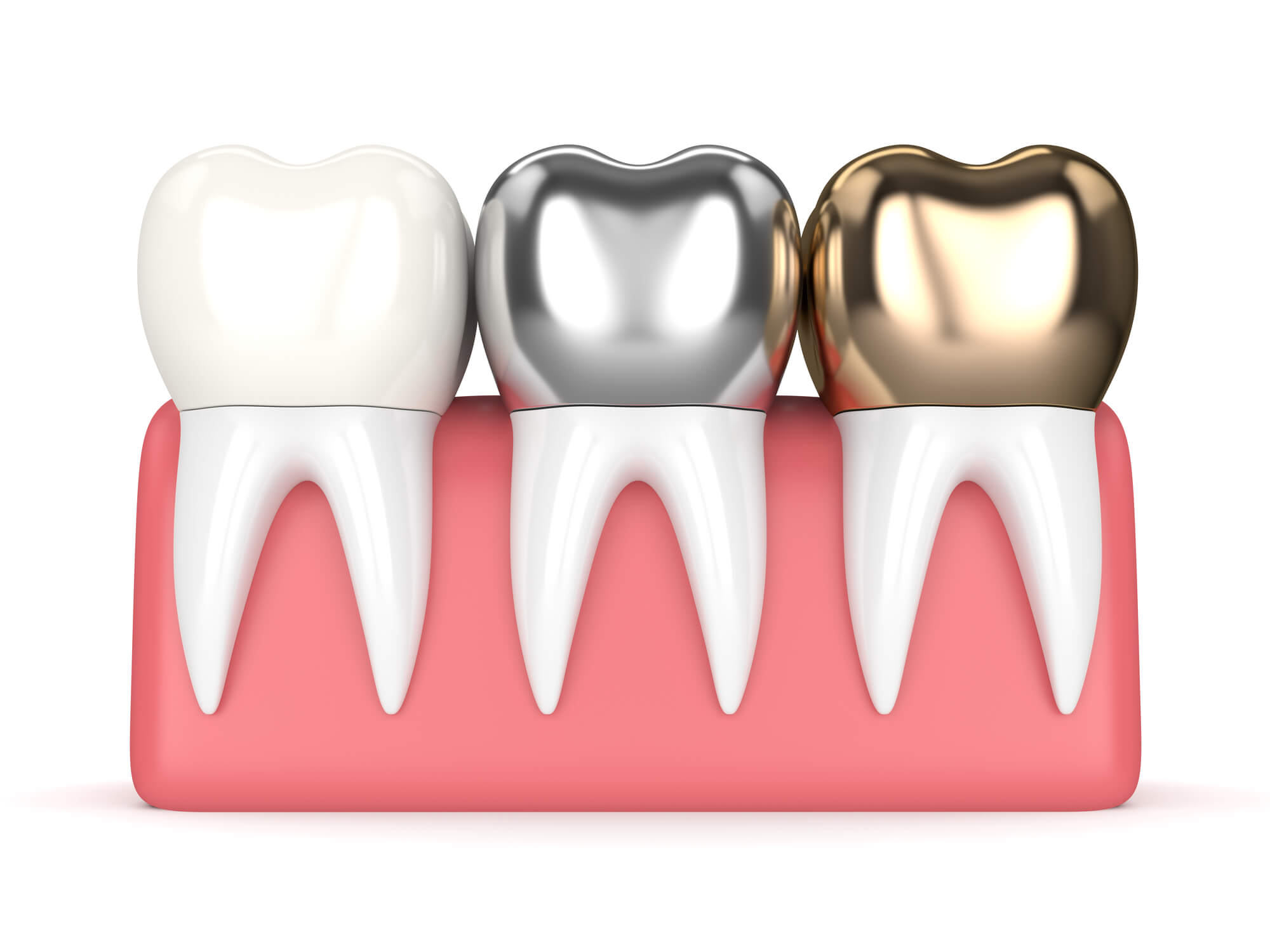 CEREC Crowns vs. Traditional Crowns: A Comparison
