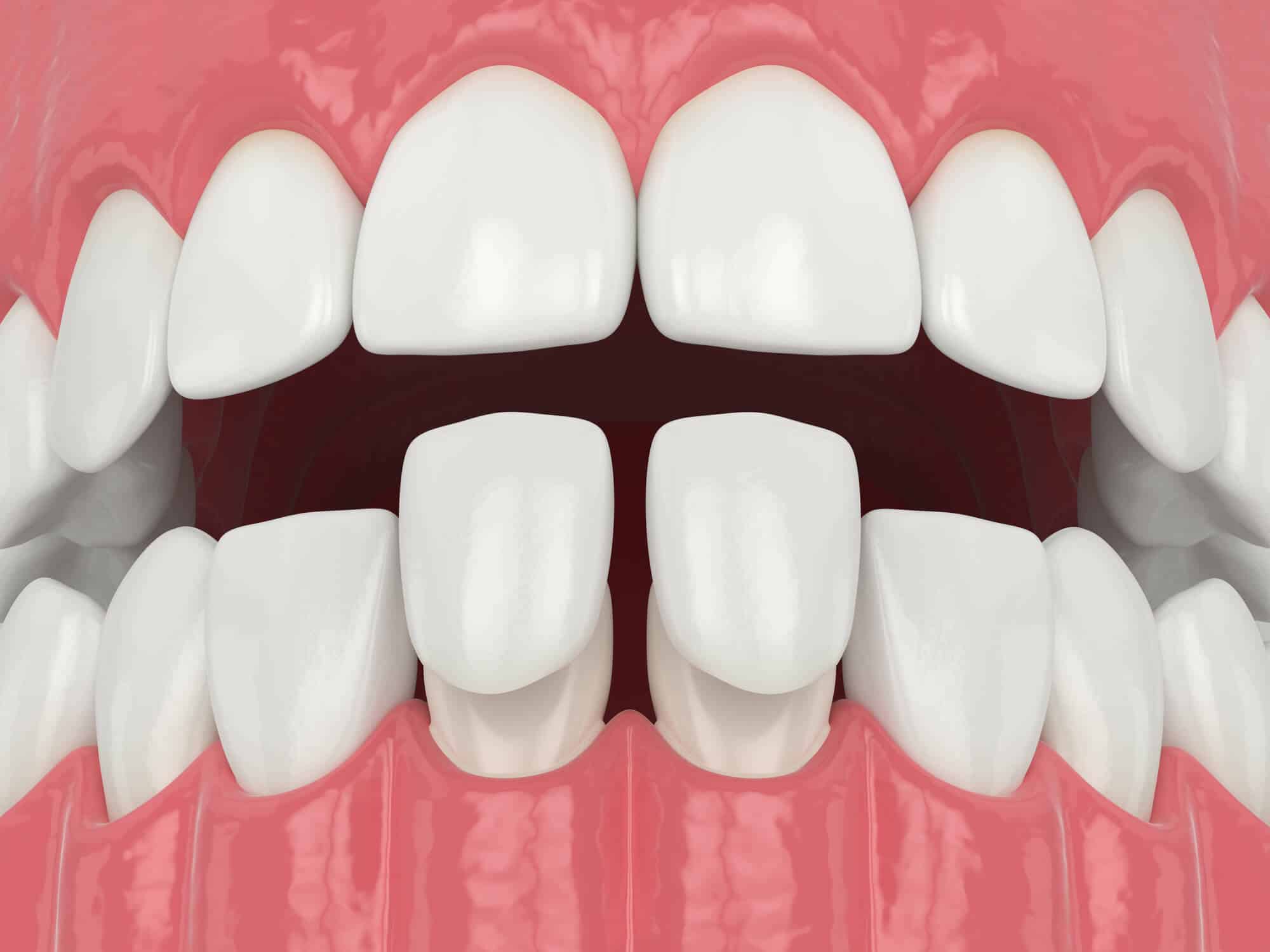 How Veneers Can Improve the Appearance of Your Smile