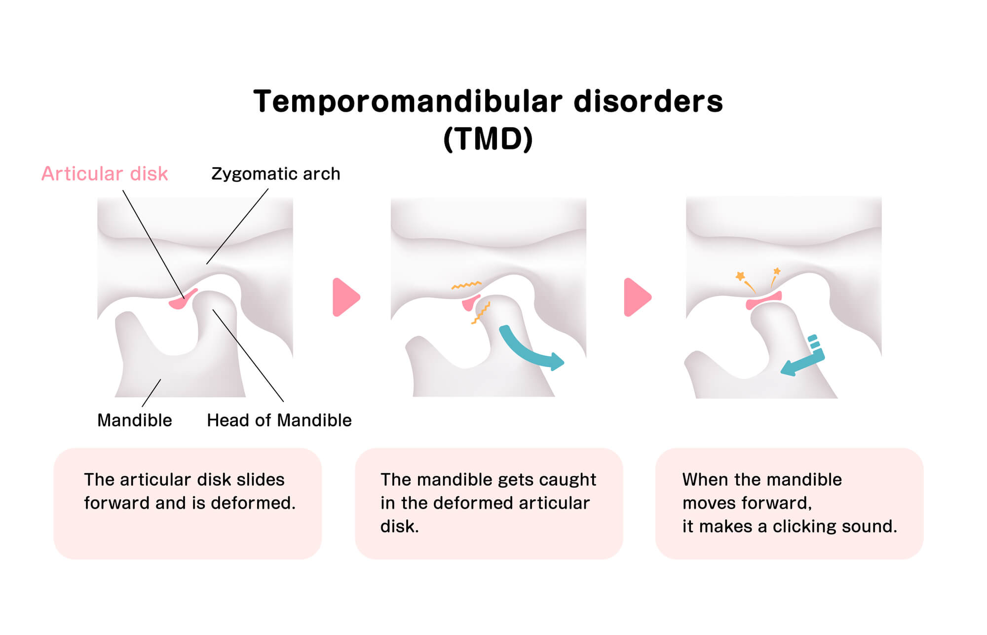 Understanding TMJ and TMD Differences