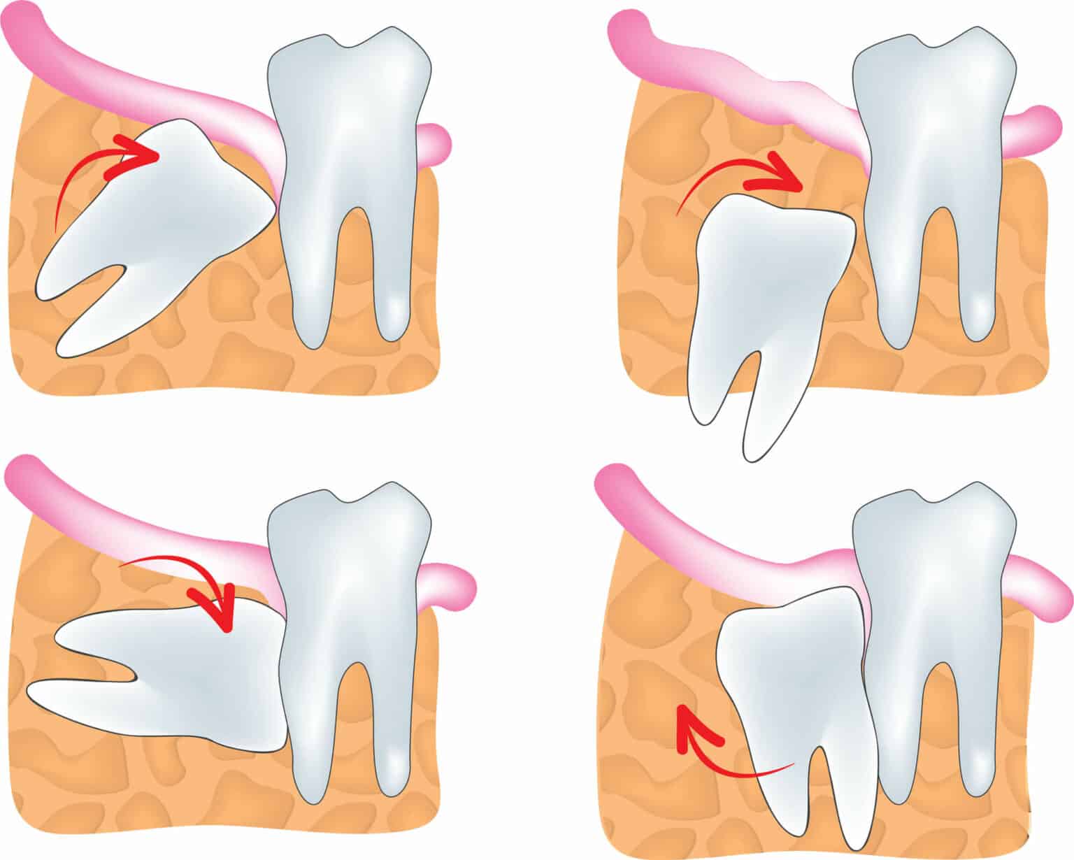 Impacted Wisdom Teeth: Causes, Risks, and Treatment